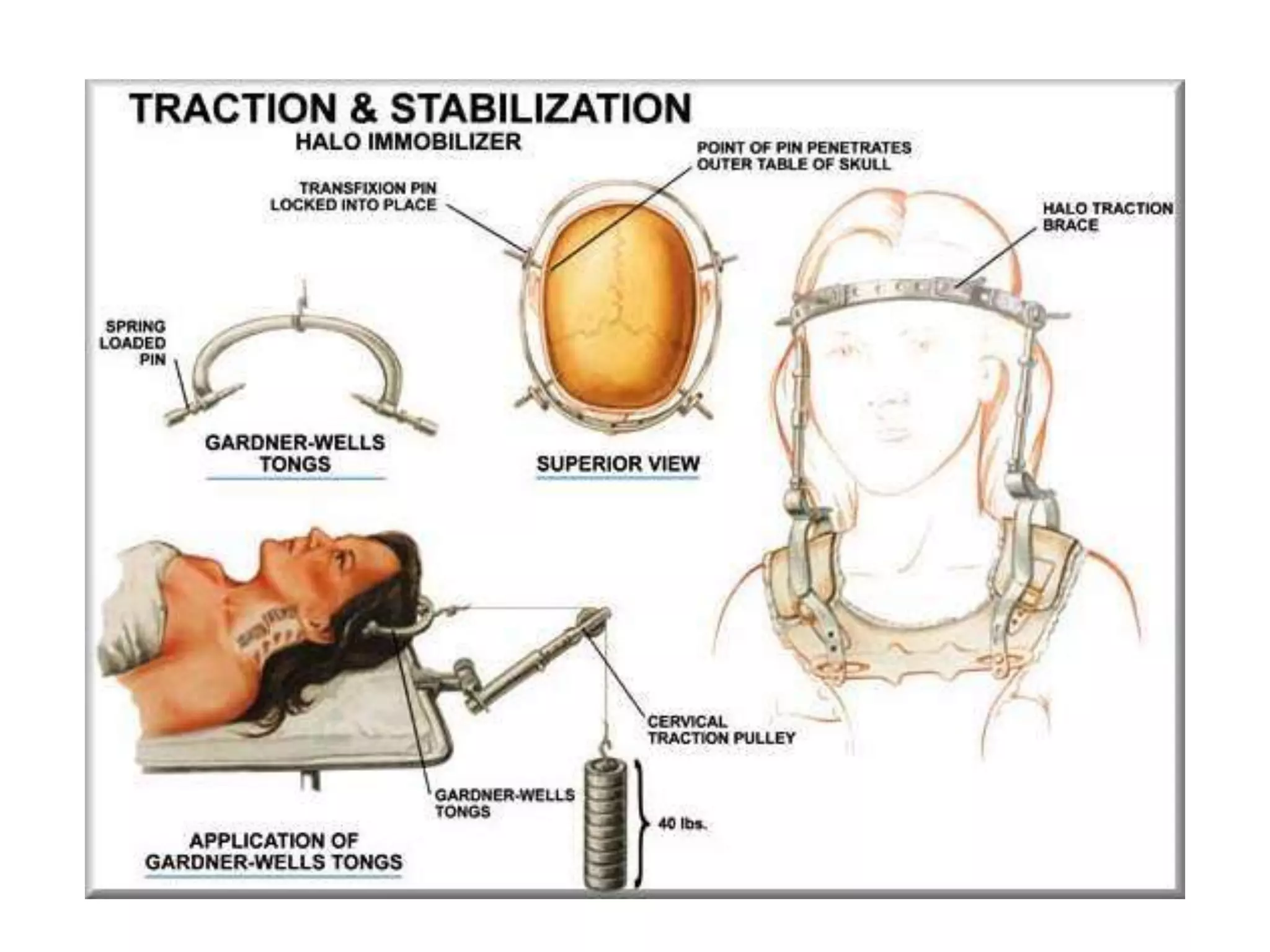 Quadriplegia & Paraplegia | PPTX