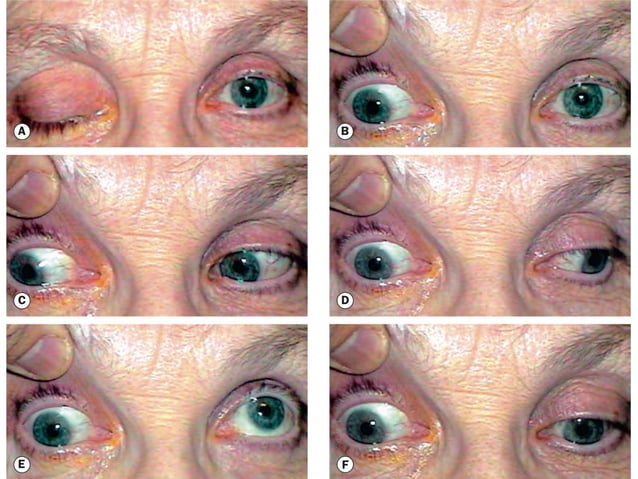 3rd cranial nerve palsy | PDF | Brain and Nervous System Disorders ...