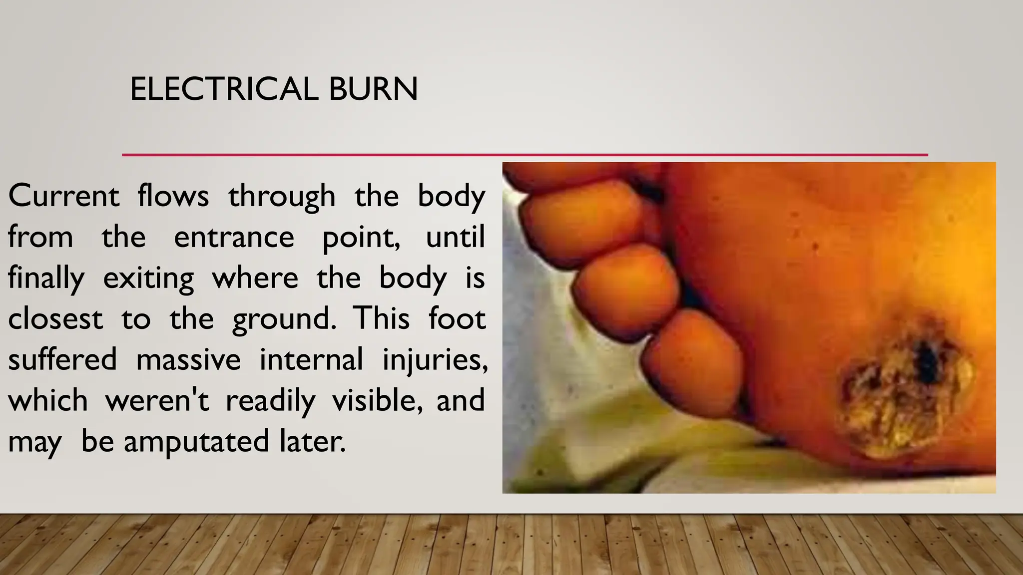 3rd Lecture Burn Rehabilitation٦.pdf