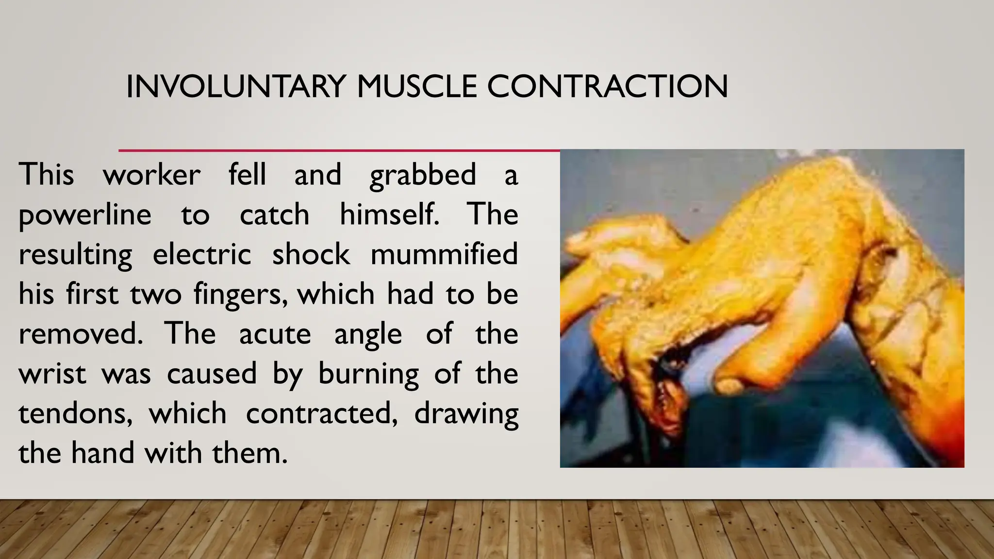 3rd Lecture Burn Rehabilitation٦.pdf