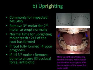 Impacted Mandibular 3rd Molar & other teeth than 3rd molar | PPTX