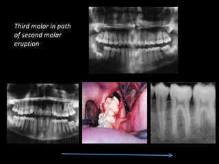 Impacted Mandibular 3rd Molar & other teeth than 3rd molar | PPTX