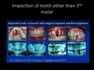 Impacted Mandibular 3rd Molar & other teeth than 3rd molar | PPTX