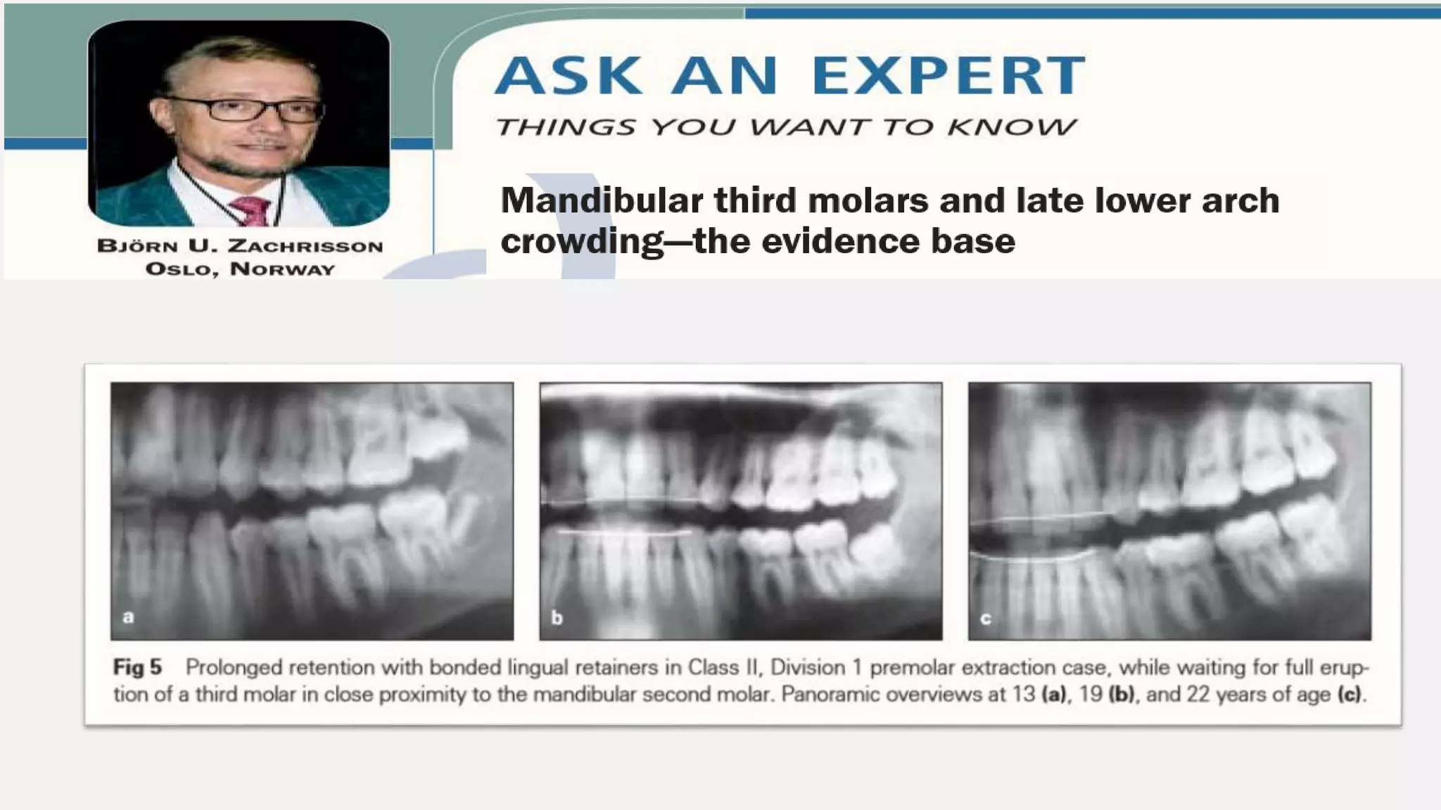 Mandibular third molars and late lower arch crowding – the evidence ...