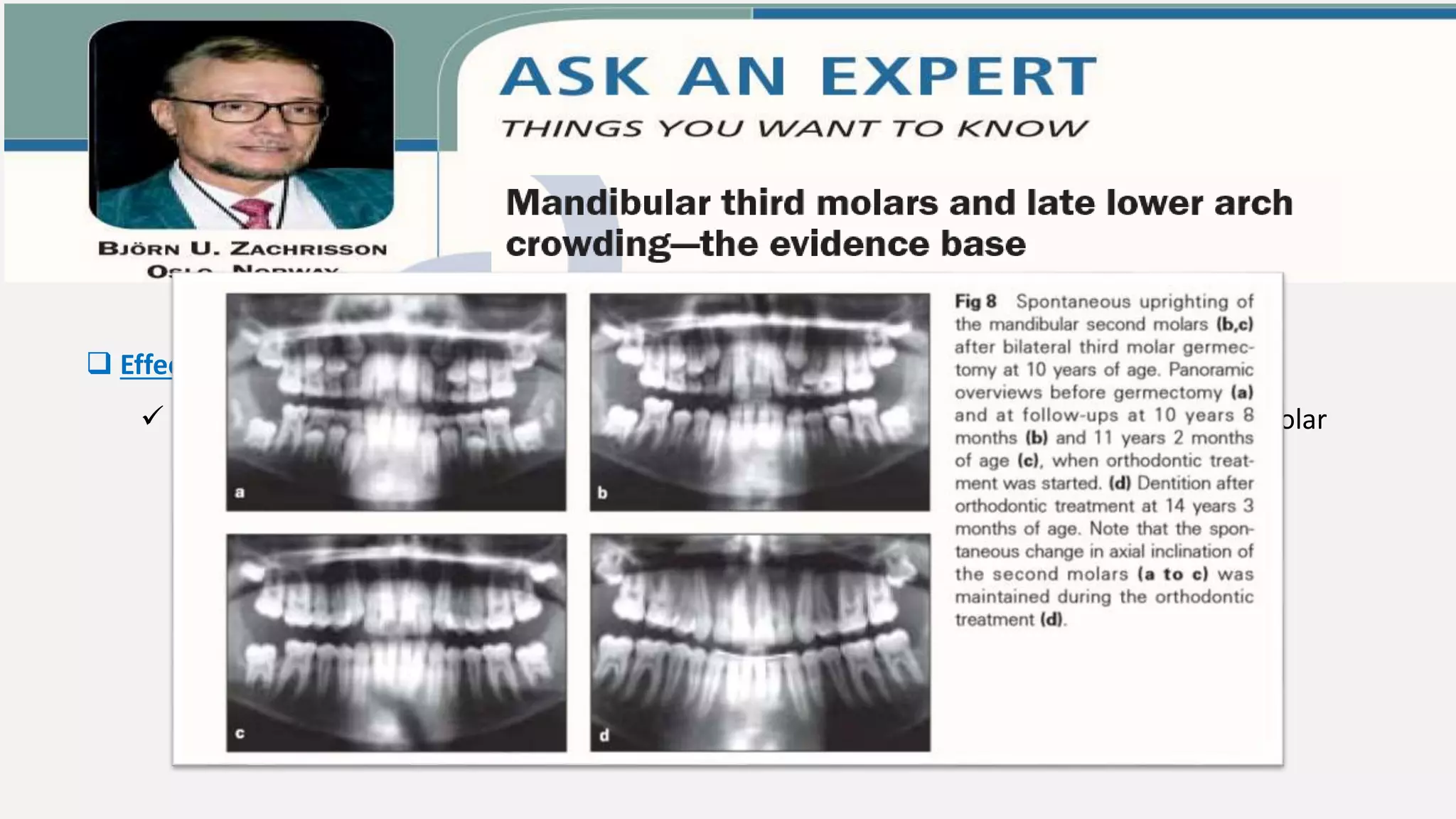 Mandibular third molars and late lower arch crowding – the evidence ...
