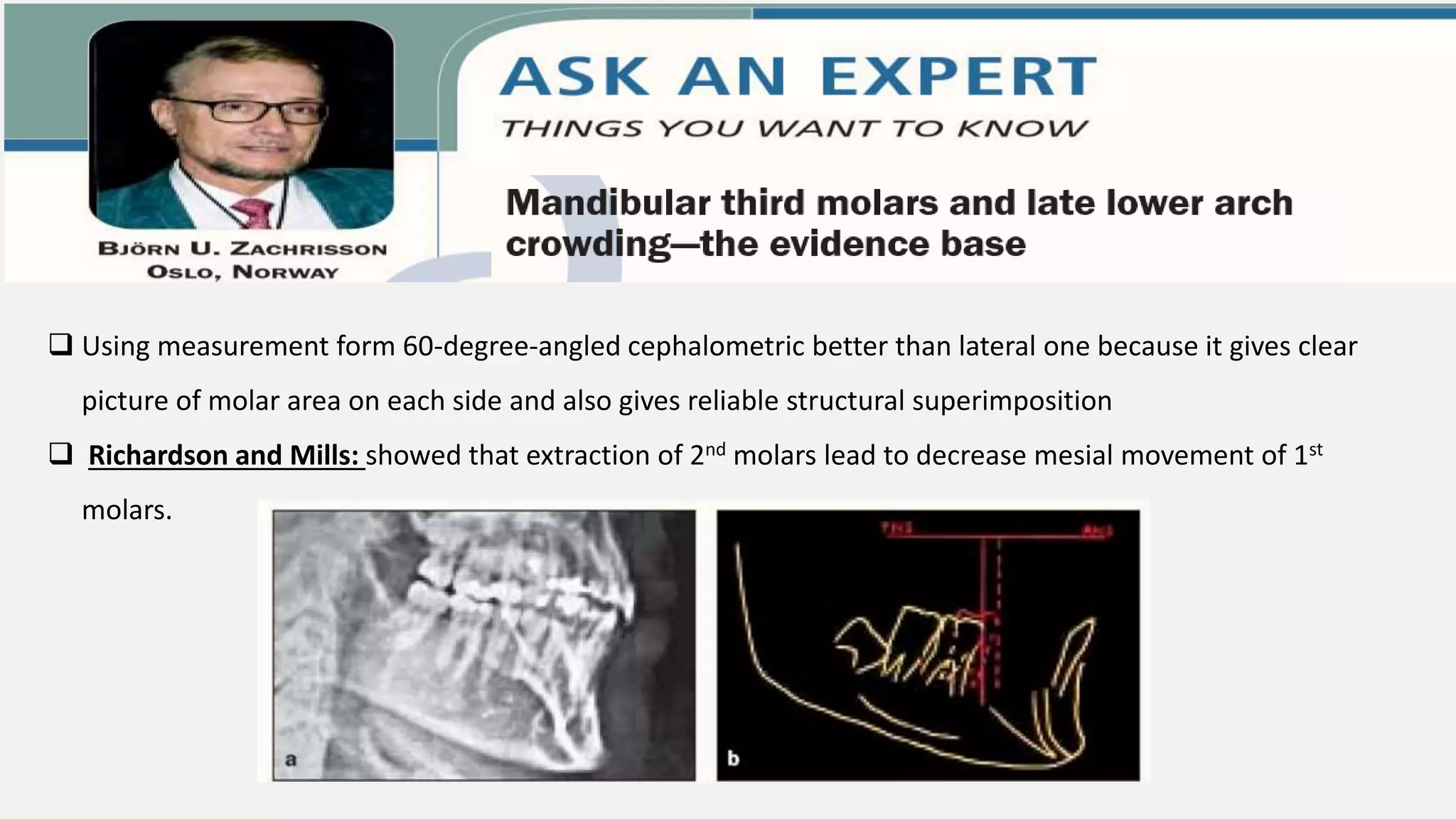 Mandibular third molars and late lower arch crowding – the evidence ...