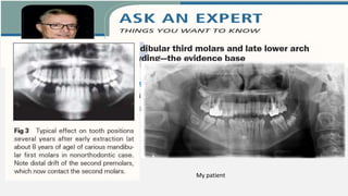 Mandibular third molars and late lower arch crowding – the evidence ...