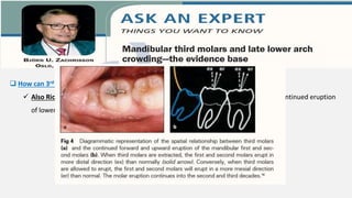 Mandibular third molars and late lower arch crowding – the evidence ...