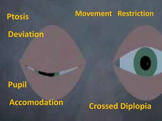 3rd cranial nerve | PPTX