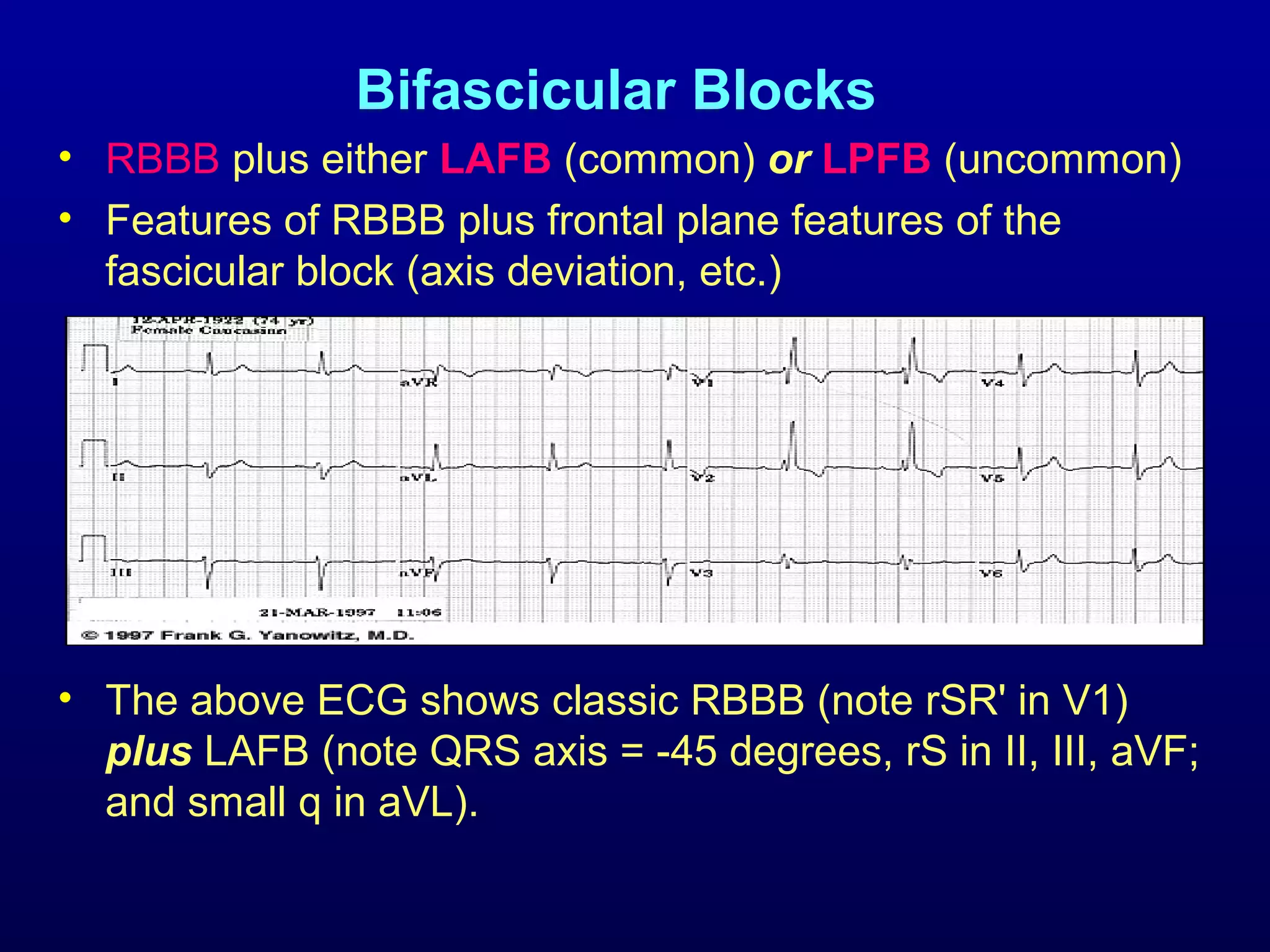 3rd Part Ecg Basics Qrs Complex Dr Salah Mabrouk Khallaf Ppt