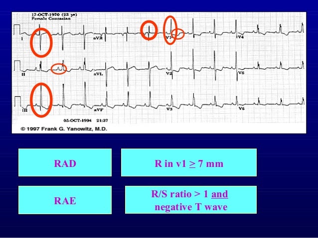 3rd part ECG Basics QRS complex Dr Salah Mabrouk Khallaf