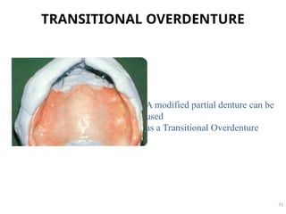 Overdentures in prosthodontic and implant dentistry | PPTX