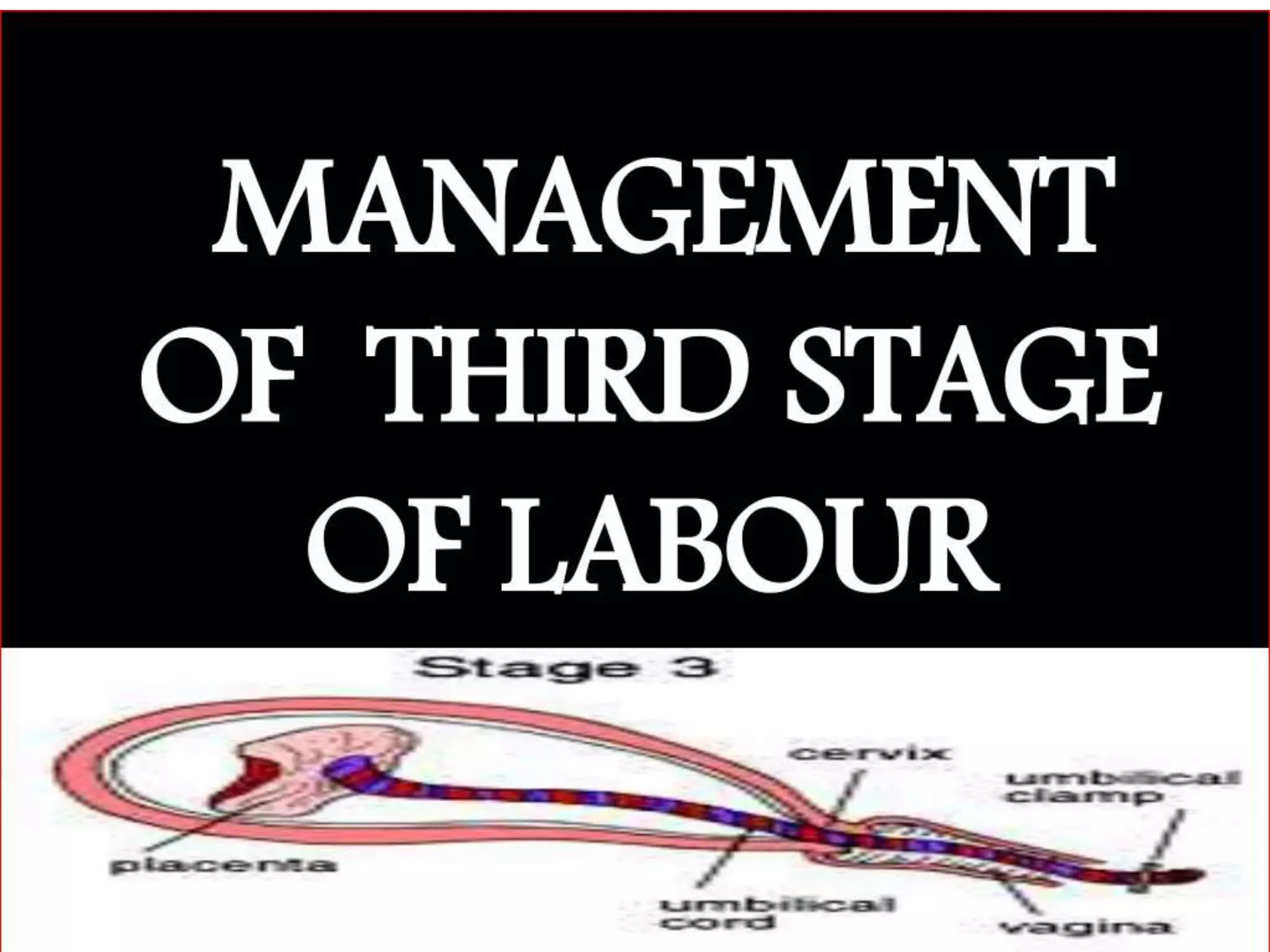 3rd stage of labor.ppt