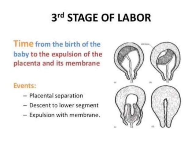3rd stage of labour and its complications