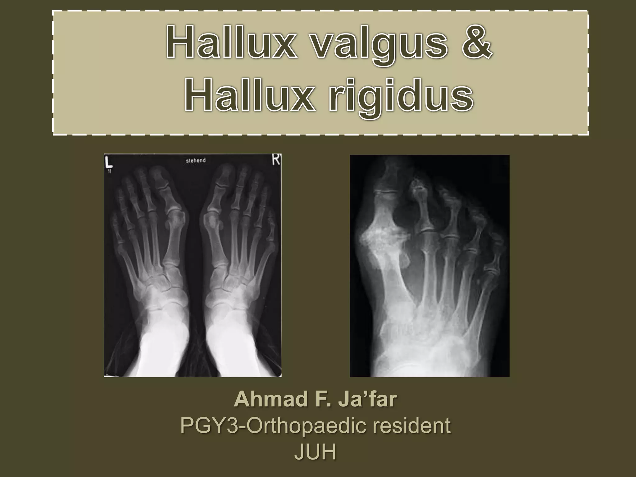 hallux valgus & hallux rigidus | PPTX