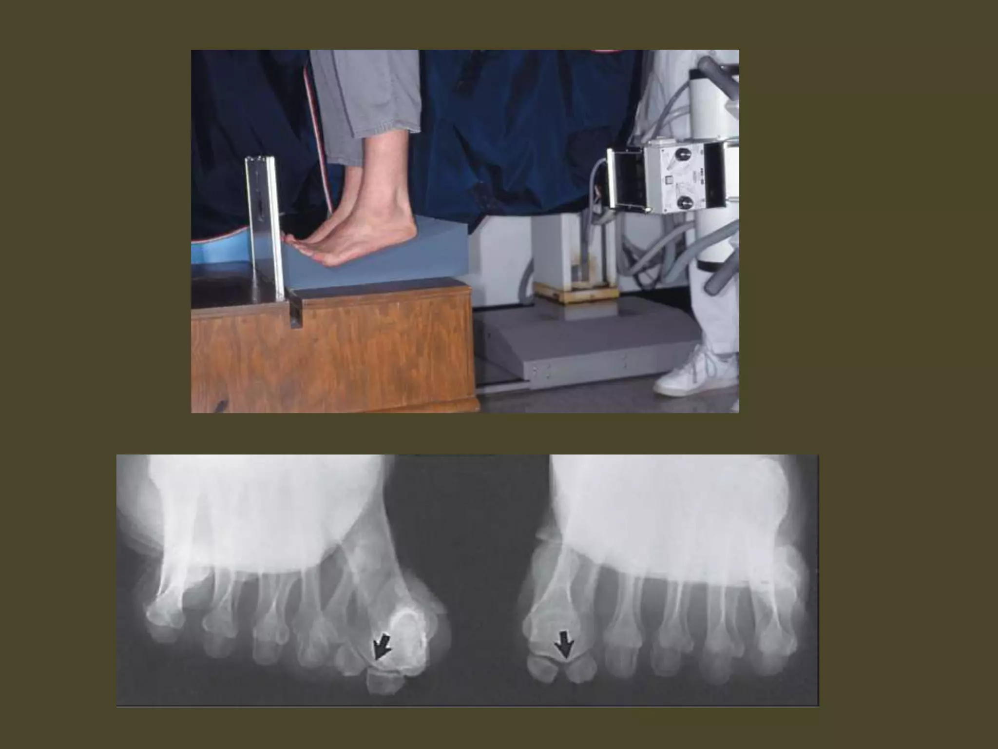 hallux valgus & hallux rigidus | PPTX