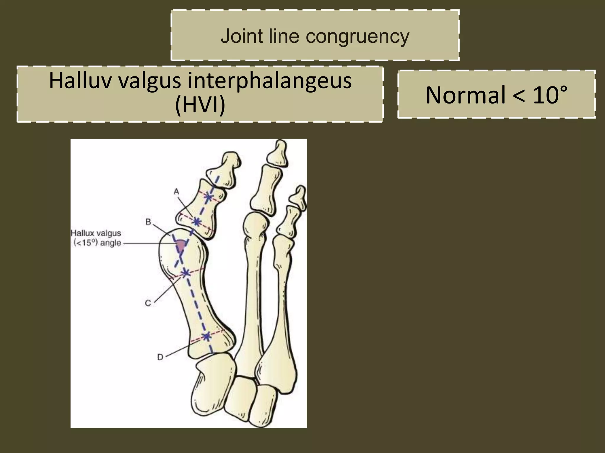 hallux valgus & hallux rigidus | PPTX