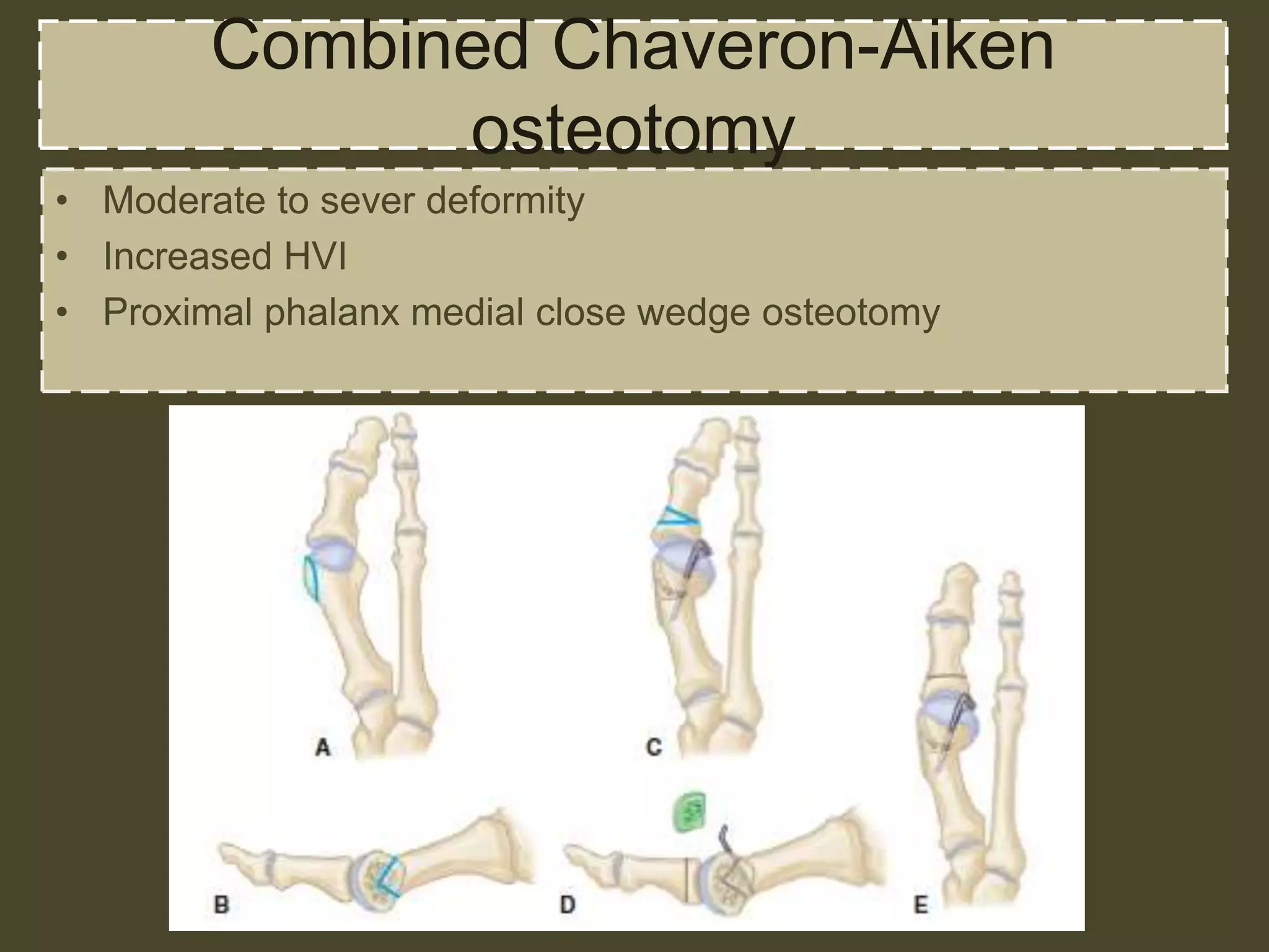 hallux valgus & hallux rigidus | PPTX