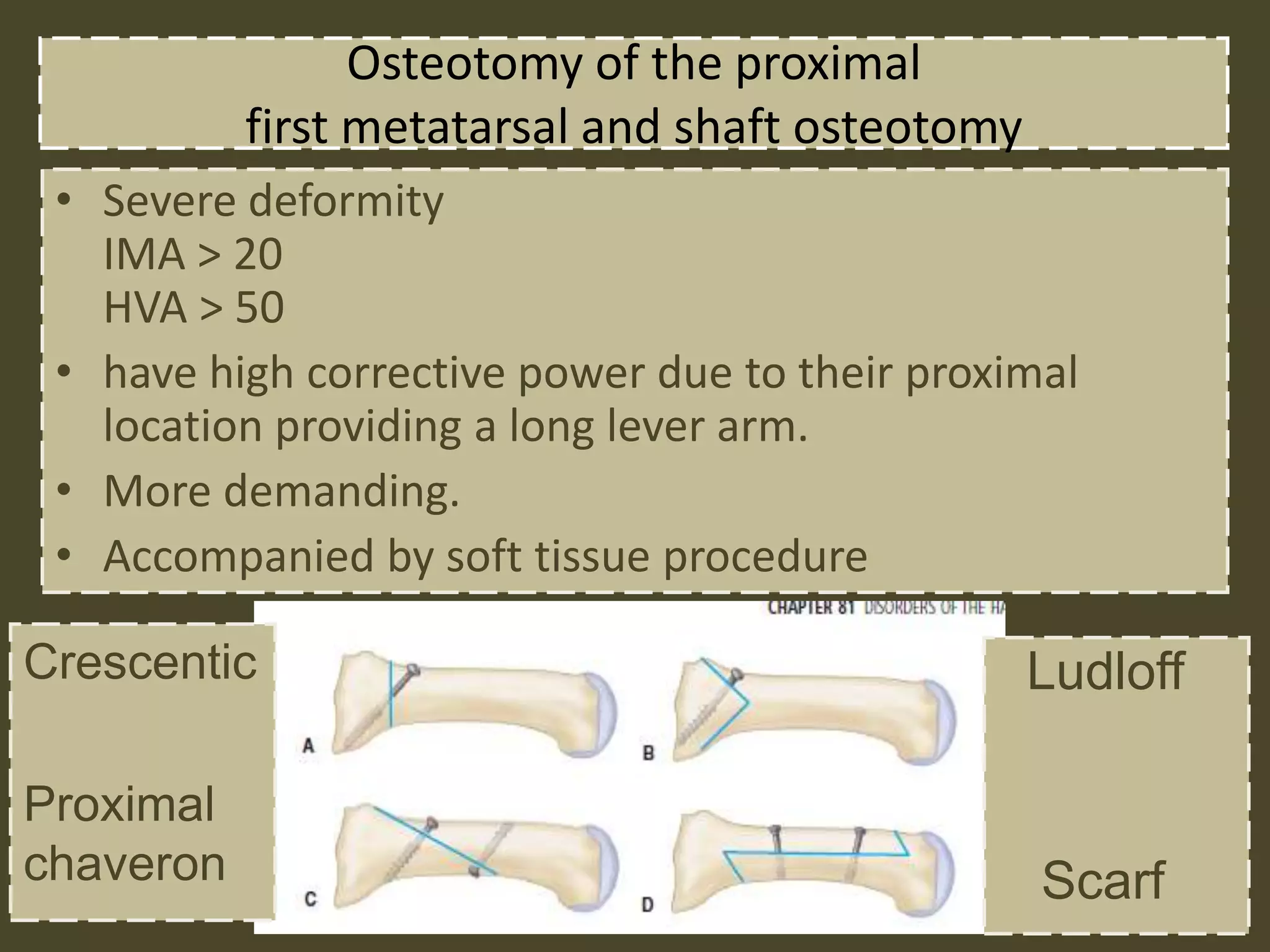 hallux valgus & hallux rigidus | PPTX