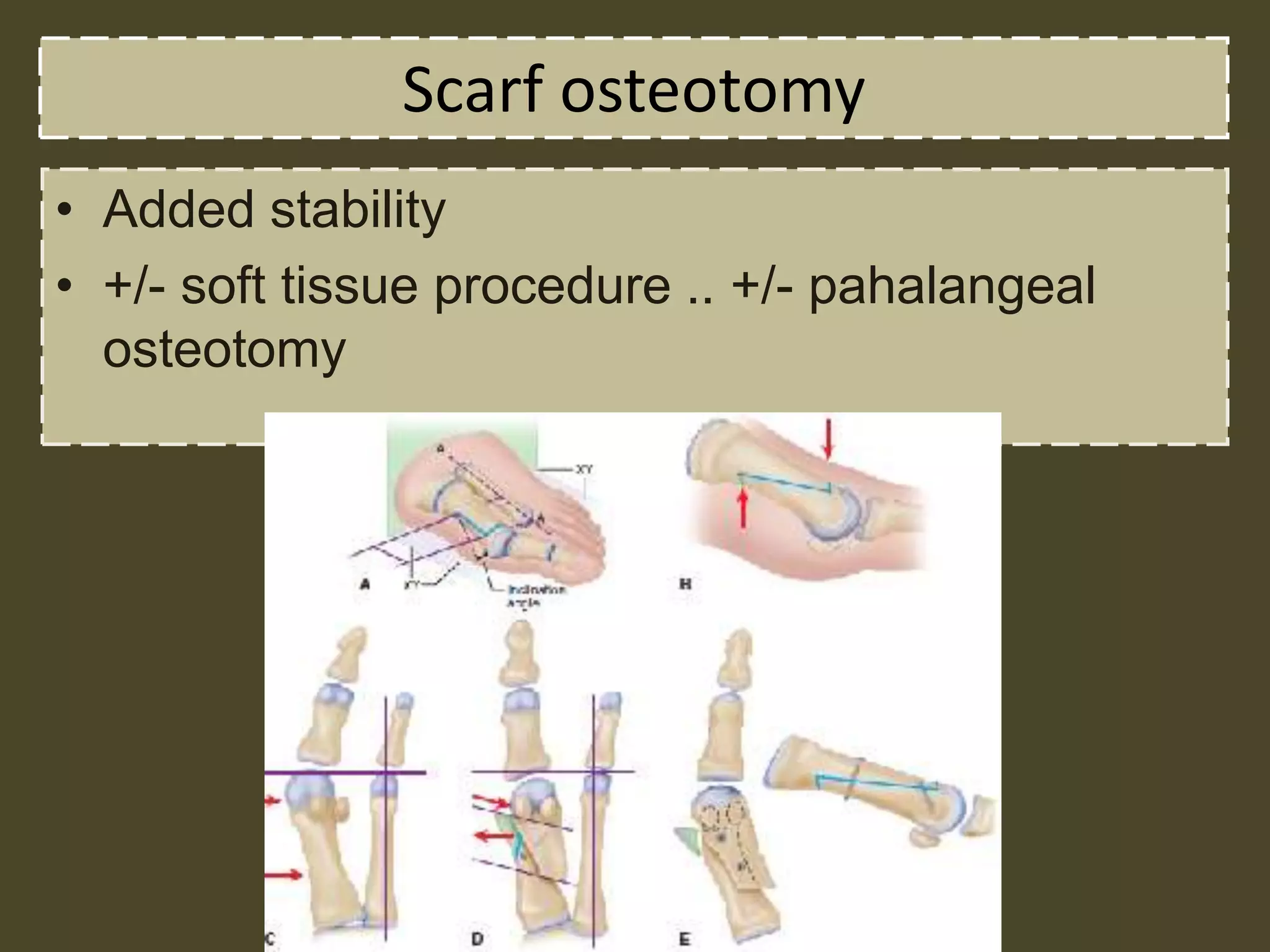 hallux valgus & hallux rigidus | PPTX