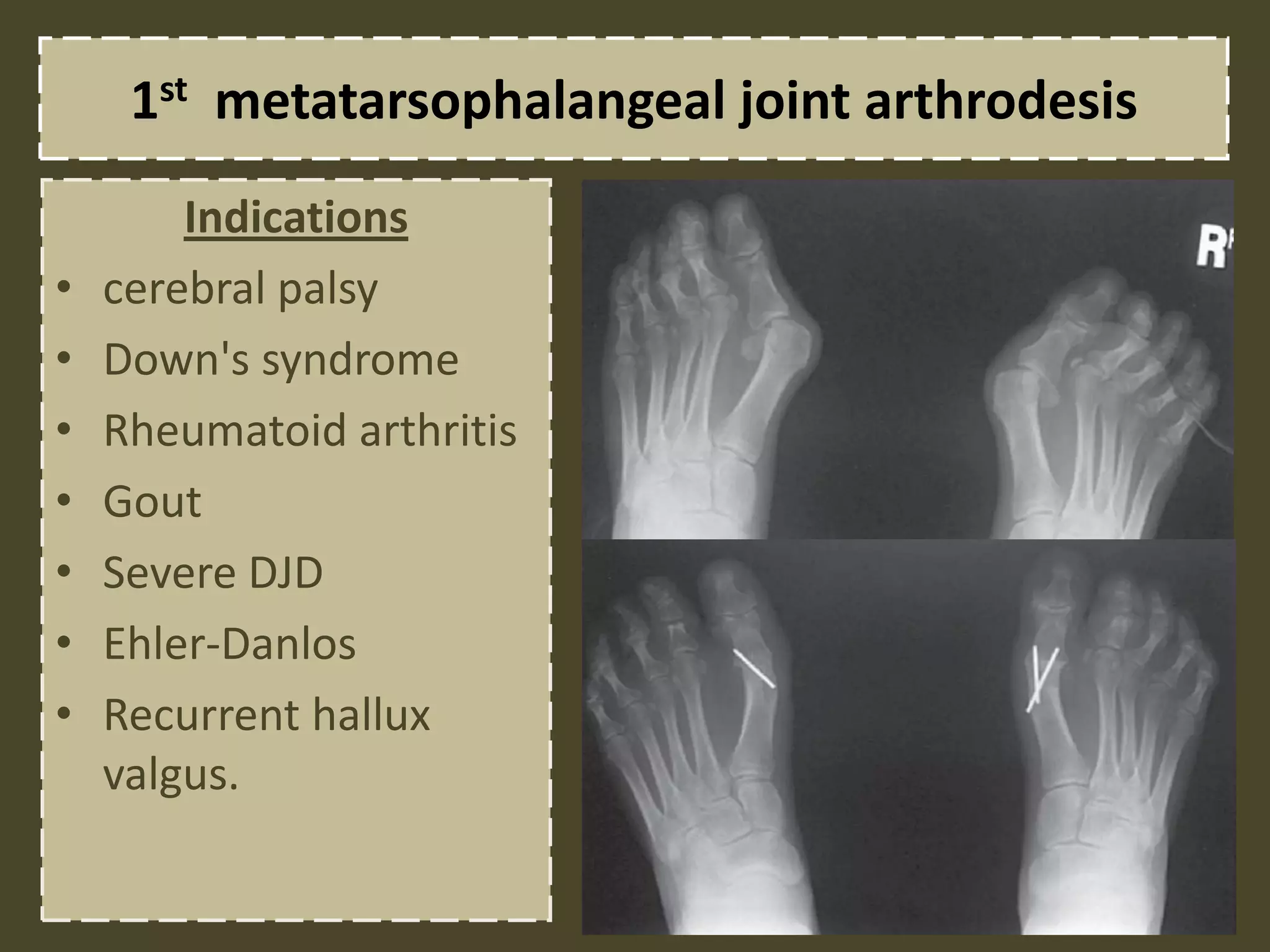hallux valgus & hallux rigidus | PPTX