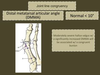hallux valgus & hallux rigidus | PPT