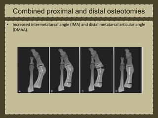 Distal Metatarsal Articular Angle