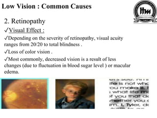 VISUAL AIDS FOR CHILDREN IN LOW VISION AND CONTACT LENS | PPT | Free ...