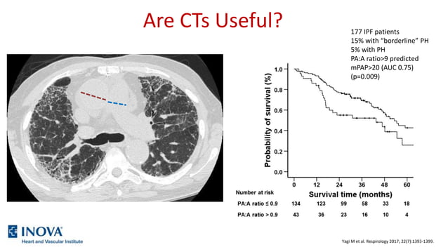 PH-ILD: Approach to Diagnosis and Treatment.pptx