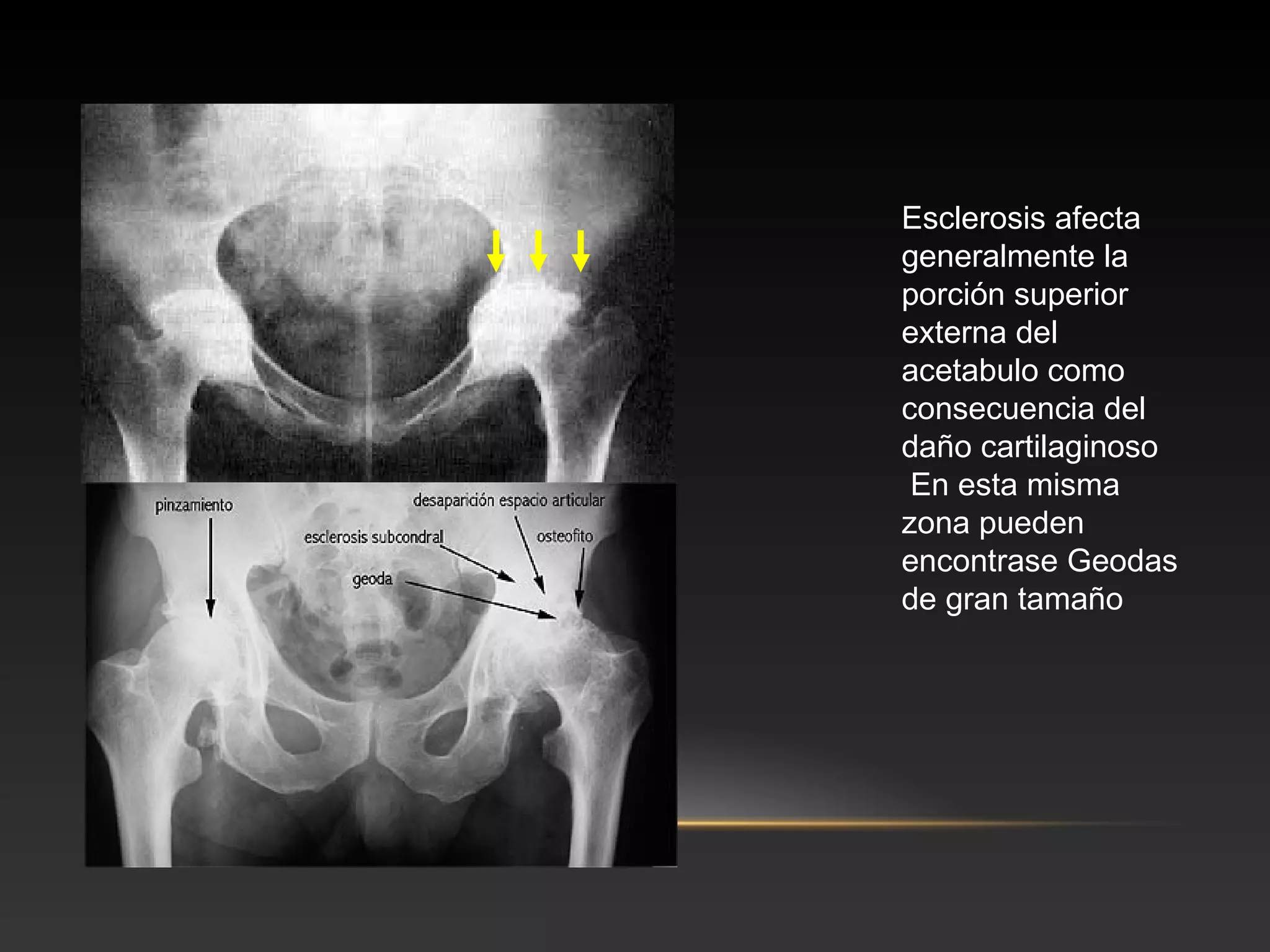 3 signos radiológicos de la enfermedad degenerativa y otros rx ...