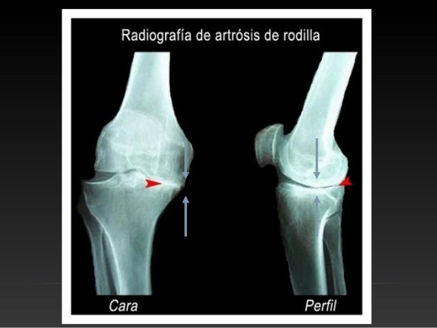 3 signos radiológicos de la enfermedad degenerativa y otros rx quiro…