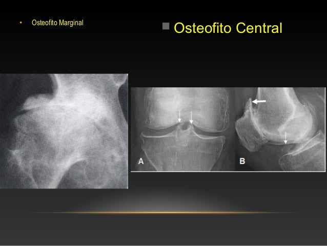 3 signos radiológicos de la enfermedad degenerativa y otros rx quiro…