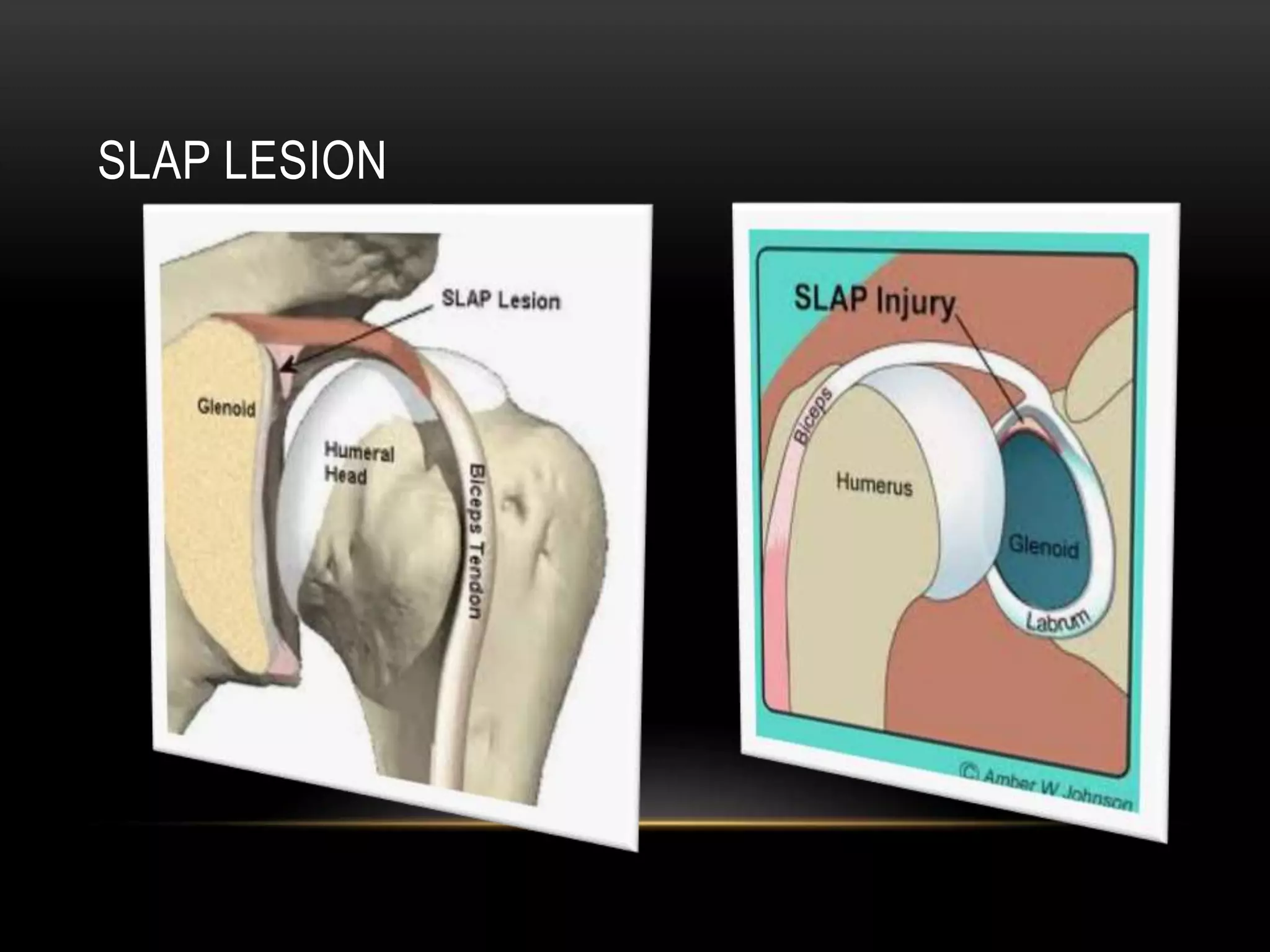 SLAP PRODROME -PHYSIOTHERAPEUTICS | PPTX
