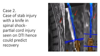 functional MRI Spinal Cord Tractography.pptx