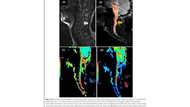 functional MRI Spinal Cord Tractography.pptx