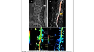 functional MRI Spinal Cord Tractography.pptx