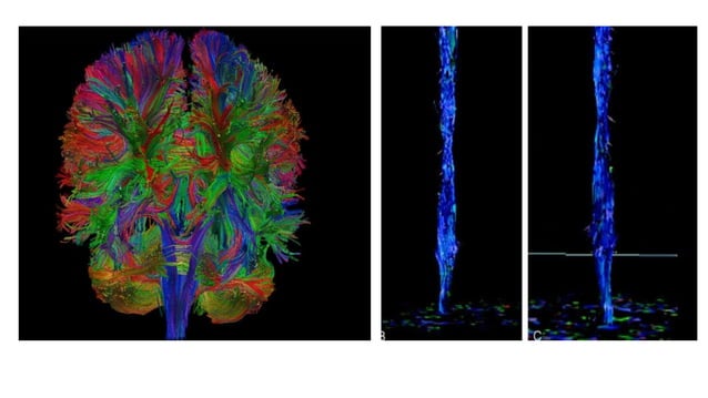functional MRI Spinal Cord Tractography.pptx