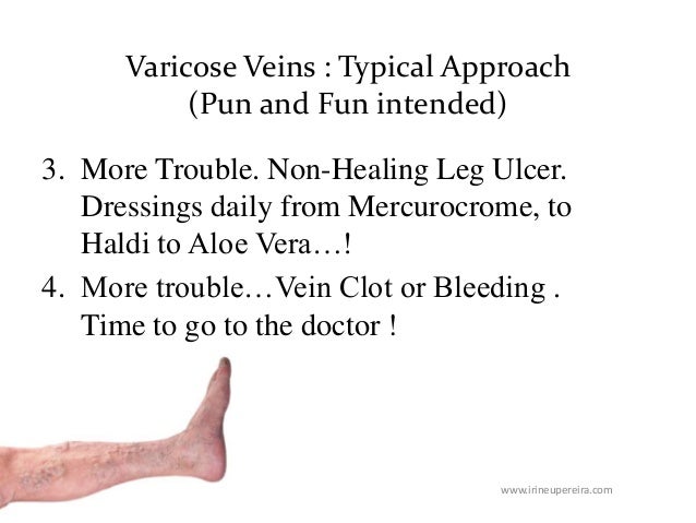 3 steps to simplified varicose veins management