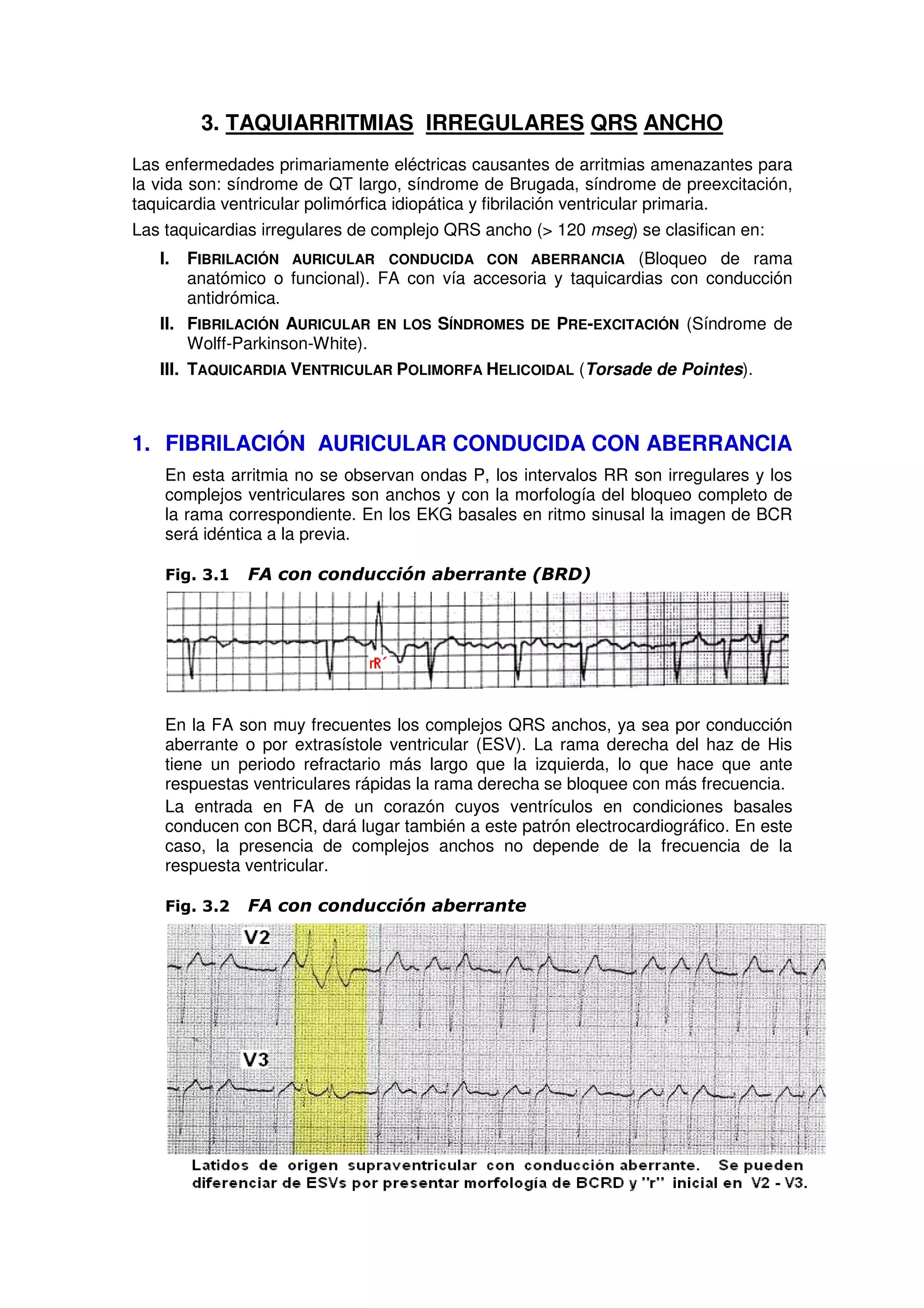 Taquiarritmias irregulares QRS ancho | PDF