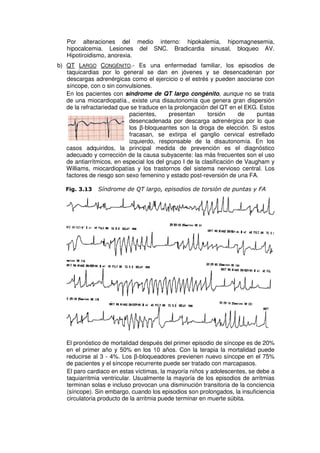 Taquiarritmias irregulares QRS ancho | PDF