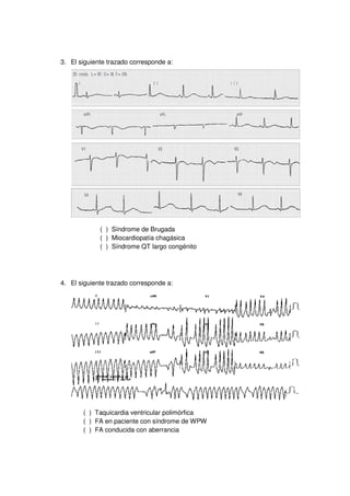 Taquiarritmias irregulares QRS ancho | PDF