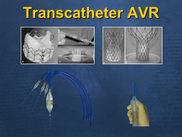 Transcatheter Aortic Valve Replacement (TAVR): Established and Emerging ...