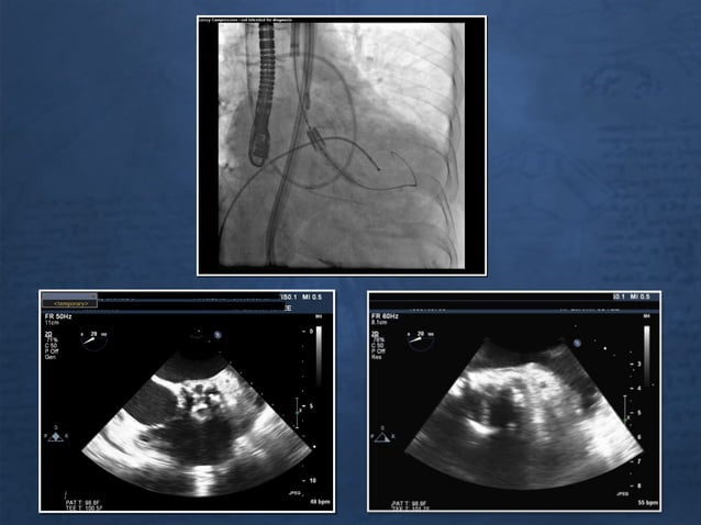 Transcatheter Aortic Valve Replacement (TAVR): Established and Emerging ...