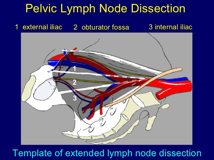 External Iliac Node