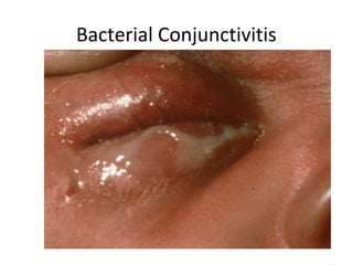 Conjunctiva | PPT