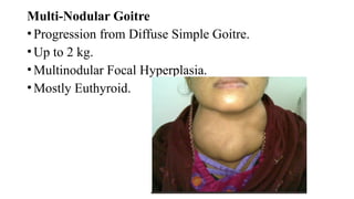 3) Thyroidectomy with all associated notes.pptx