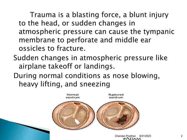 Trauma or Perforation in tympanum.ppt
