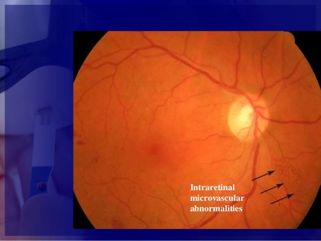 Diabetic retinopathy