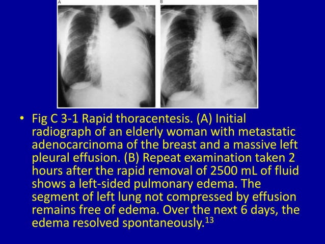 3 unilateral pulmonary edema pattern | PPT