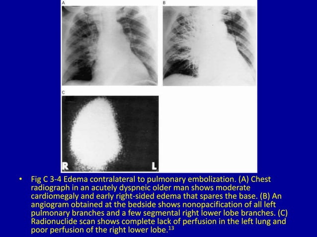 3 unilateral pulmonary edema pattern | PPT